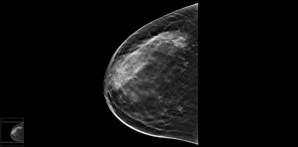 Monitoring | Lobular Breast Cancer UK